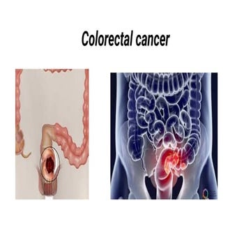 Colorectal cancer.pdf | Digestive Disorders | Diseases and Conditions