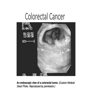 Colorectal cancer presentation | PPT