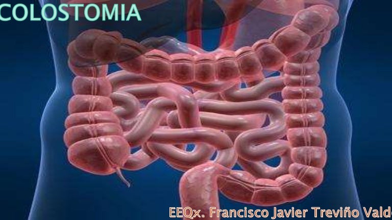Colostomia