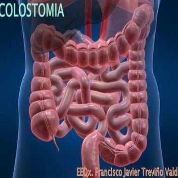 COLOSTOMIA - TECNICA QUIRURGICA E INSTRUMENTAL | PPTX
