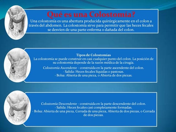 Colostomía presentacion | PPT
