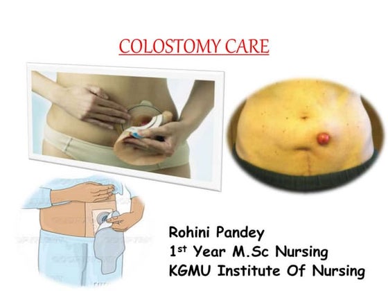 Colostomy care : Nursing management | PDF