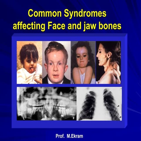 Common syndromes affecting the head & neck | PPT