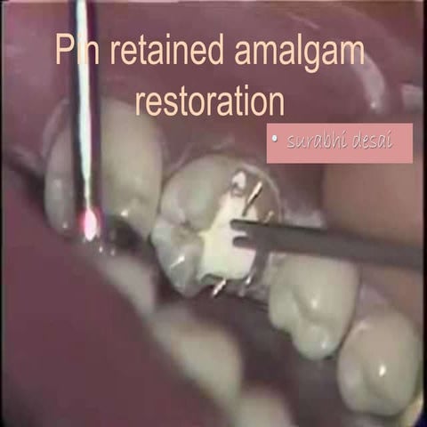 Pin retained restorations | PPTX