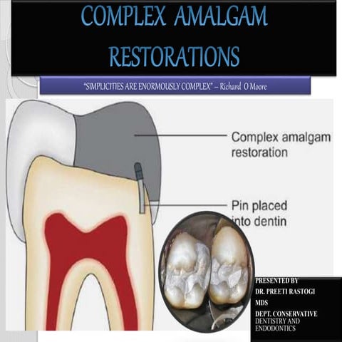 Complex amalgam restoration | PPTX