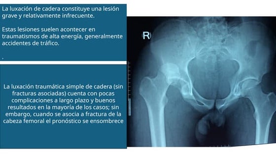 Abducción y aduccion de cadera.ppt completo | PPT