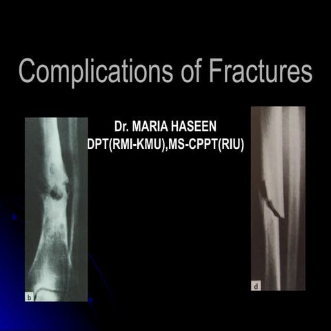 Complications of fractures.ppt this new. | PPT