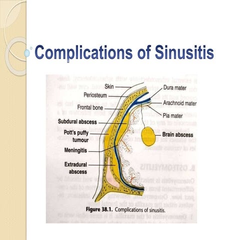 Complications of sinusitis | PPTX | Ear, Nose and Throat Conditions ...