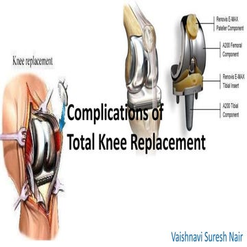 Total knee replacement nursing management | PPTX