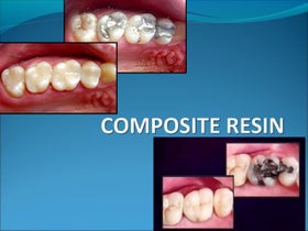 Composite resin restoration in dentistry | PPT