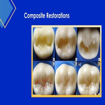 Indirect composite restorations | PPTX