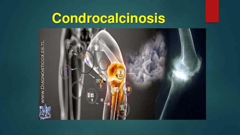 Condrocalcinosis