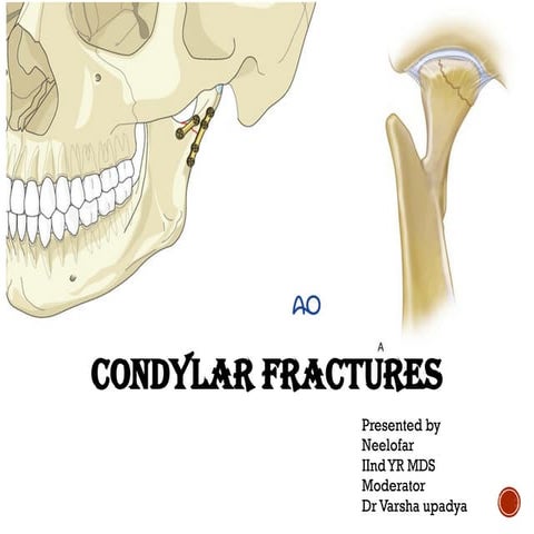 condylar fracture in oral and maxillofacial surgery | PPTX