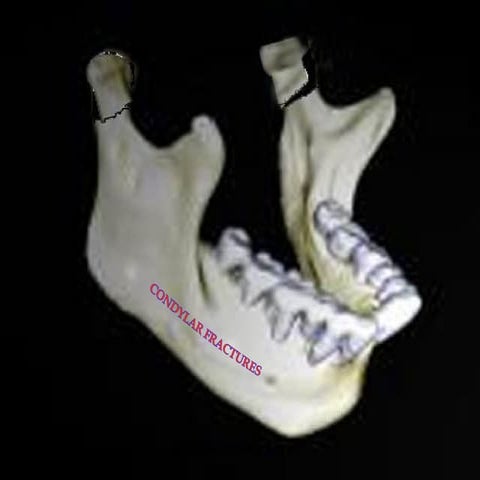 Condylar fractures /certified fixed orthodontic courses by Indian ...