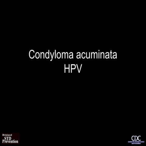 Condyloma_acuminata or study on candiasis.ppt