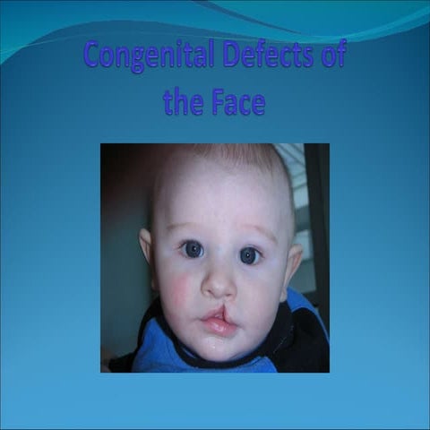 Congenital defects of the Face | PPT