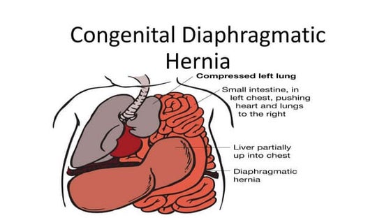 BRUNO Diaphragmatic Hernia.pptx