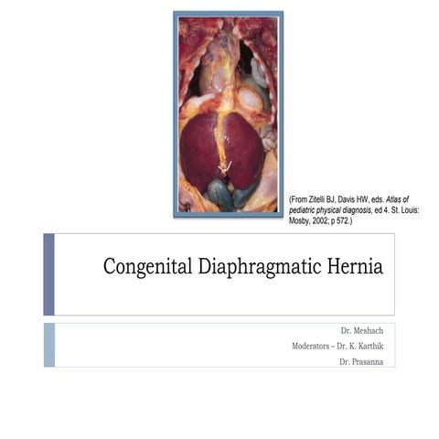 Congenital Diaphragmatic Hernia.pptx