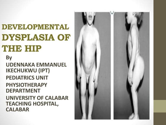 Congenital Dislocation of the Hip - PHYSIOTHERAPY | PPT
