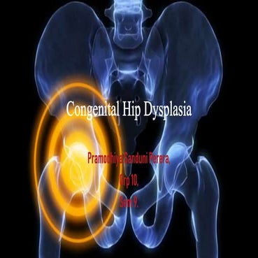 ppt aboout congenital hip dysplasia.pptx