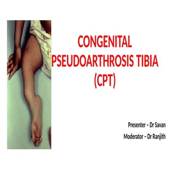 CONGENITAL PSEUDOARTHROSIS TIBIA . pptx | PPTX