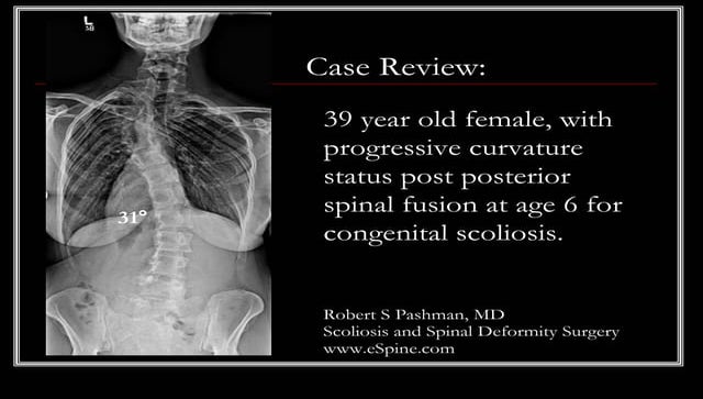 Case Review 28 Patient With Lumbar Scoliosis Status Post Surgery With