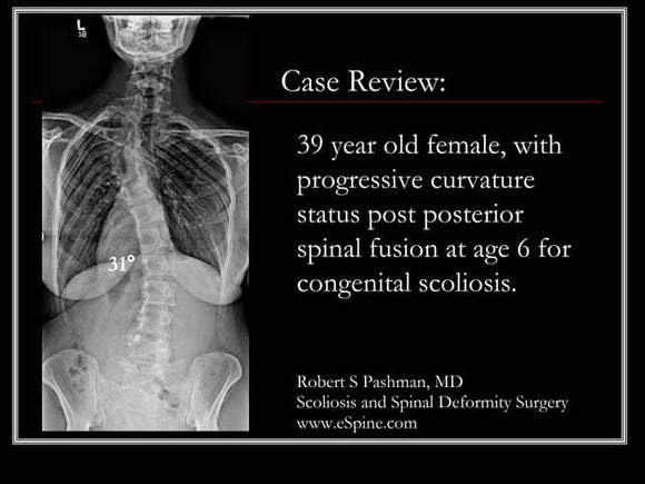 Case Review 28 Patient With Lumbar Scoliosis Status Post Surgery With
