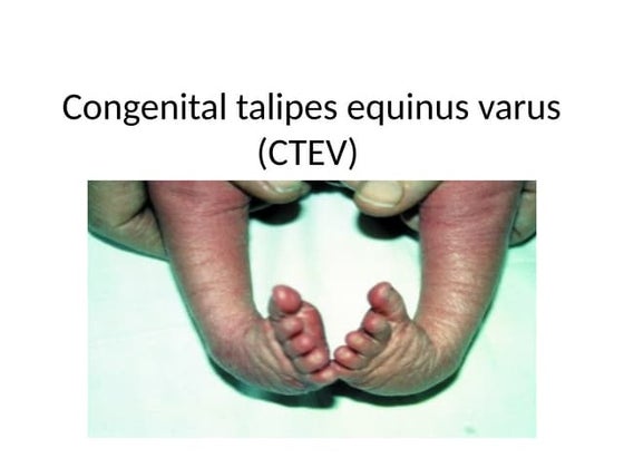 Physiotherapy for CONGENITAL TALIPES EQUINOVARUS | PPT