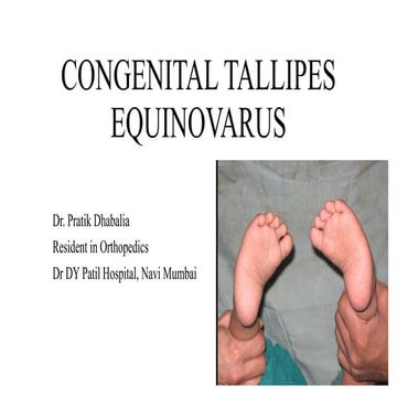 Congenital talipes equinovarus (club foot/ctev) ppt by Dr Pratik | PPTX