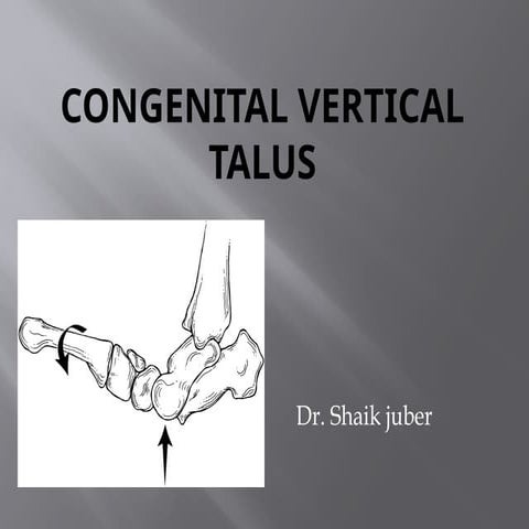 congenitalverticaltalus-160713182943.pptx