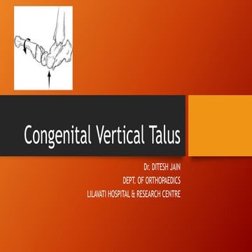 Congenital vertical talus | PPTX