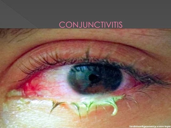 BACTERIAL_CONJUNCTIVITIS, Ocular microbiology | PPTX