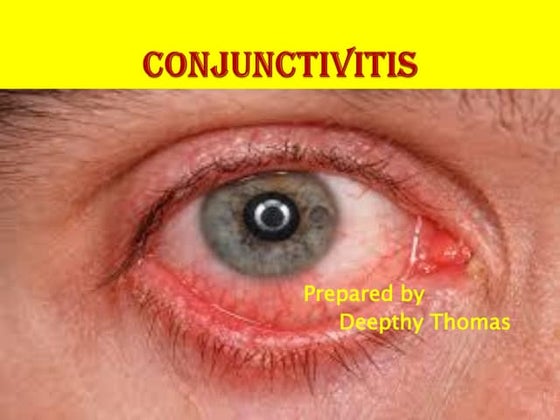 Viral Conjunctivitis.pptx