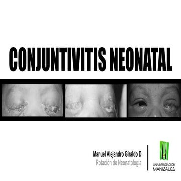 Conjuntivitis neonatal | PPTX