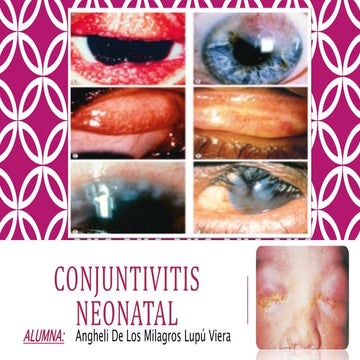 CONJUNTIVITIS NEONATAL | PPTX