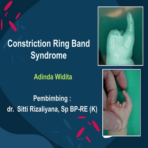 Constriction Ring Batjyjjd Syndrome.pptx