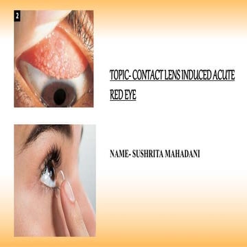 CONTACT LENS INDUCED ACUTE RED EYE.pptx