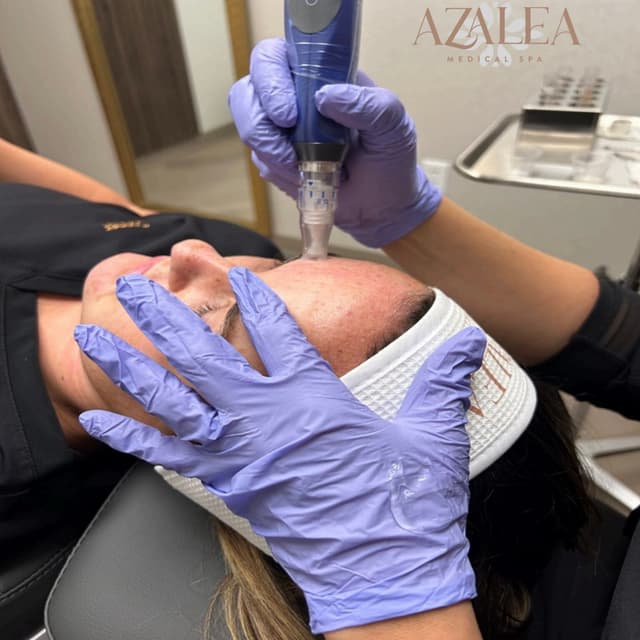 microneedling kansas city- Azalea Med Spa.pdf