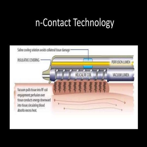 Convergent Ablation | PPT