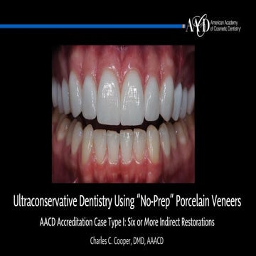 Ultraconservative Dentistry Using "No-Prep" Porcelain Veneers | PDF