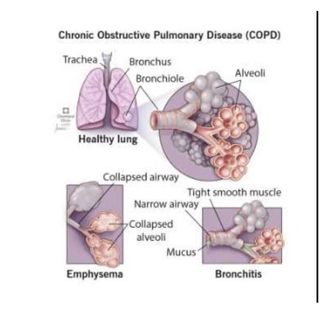 COPD(chronic obstructive pulmonary disease) ppt slideshare | PPTX