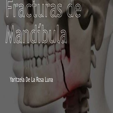 Fracturas de mandibula.pptx