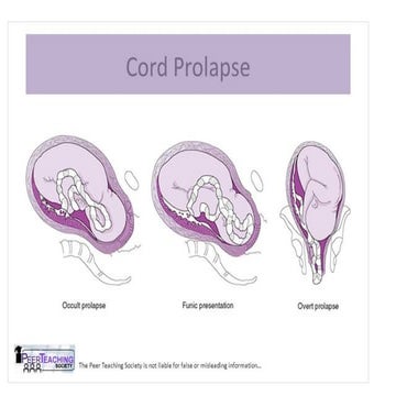 Presentation on cord prolapse and its management | PPTX