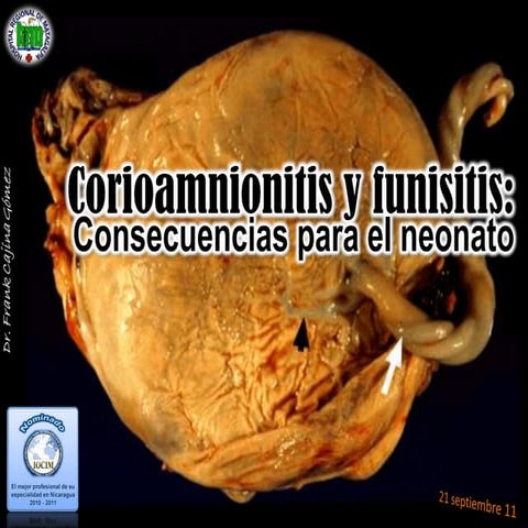 Corioamnionitis y funisitis. consecuencias para el neonato | PDF