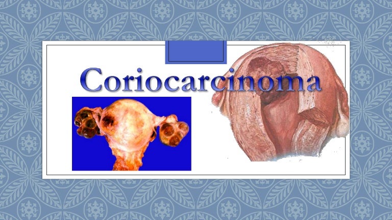 Coriocarcinoma