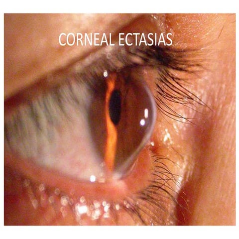 Corneal ectasias | PPTX
