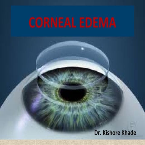 Corneal edema | PPT