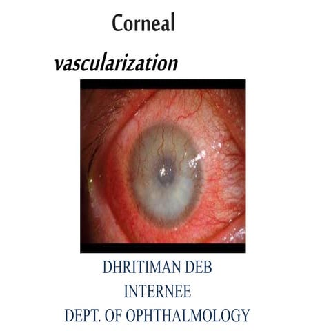 Corneal neovascularization | PPTX