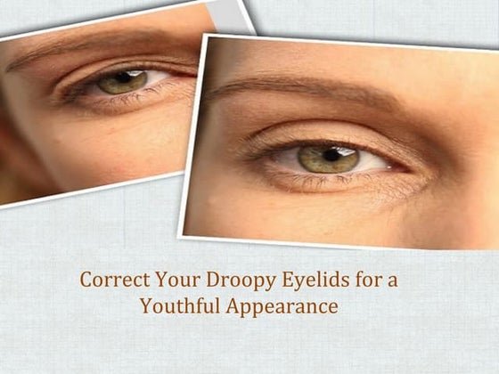 Points to remember after undergoing blepharoplasty | PPT