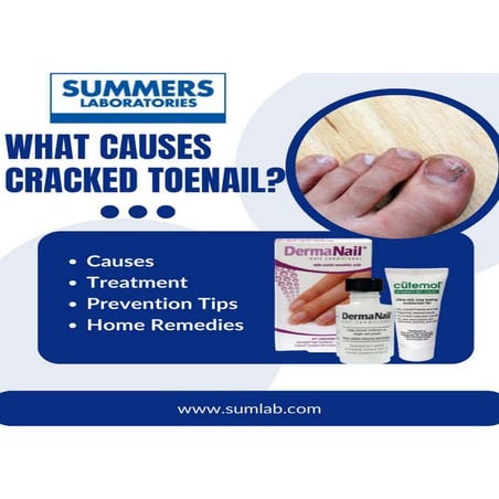 What causes a toenail to crack? How to fix a cracked toenail at home? | PDF